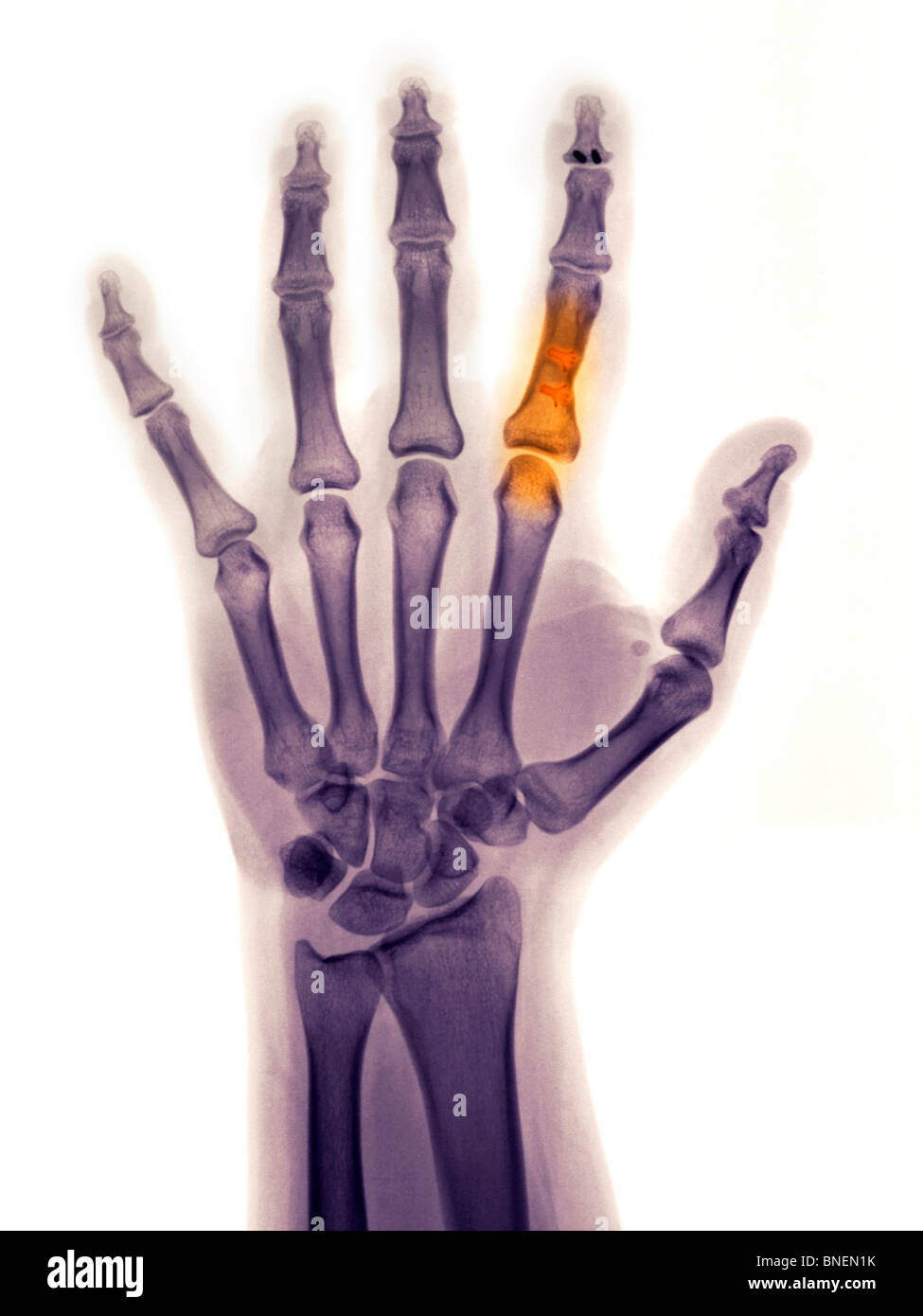 X-ray showing flexor tendon repair of the index finger Stock Photo - Alamy