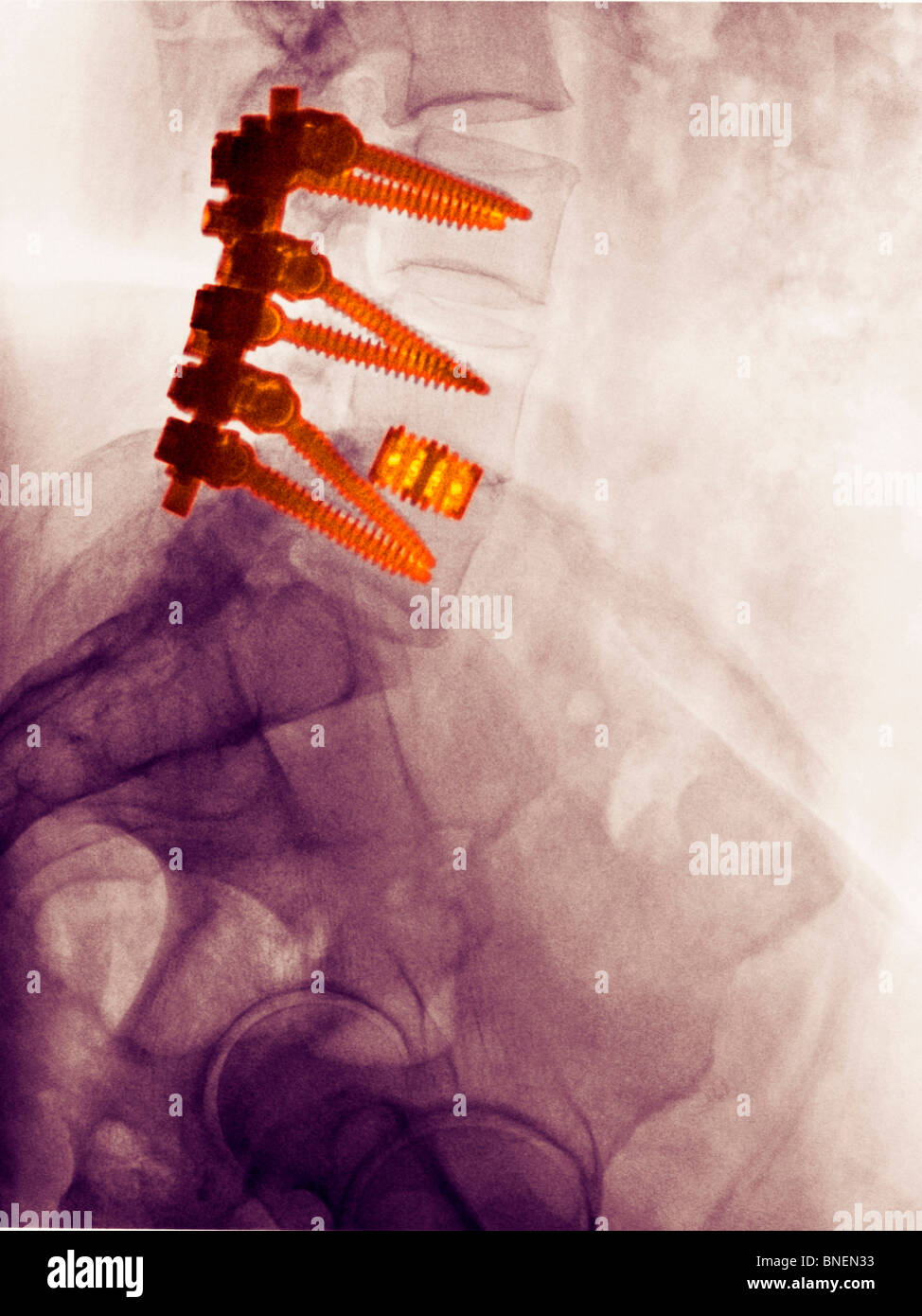 lumbar spine back x-ray of a 55 year old woman showing a spinal fusion ...