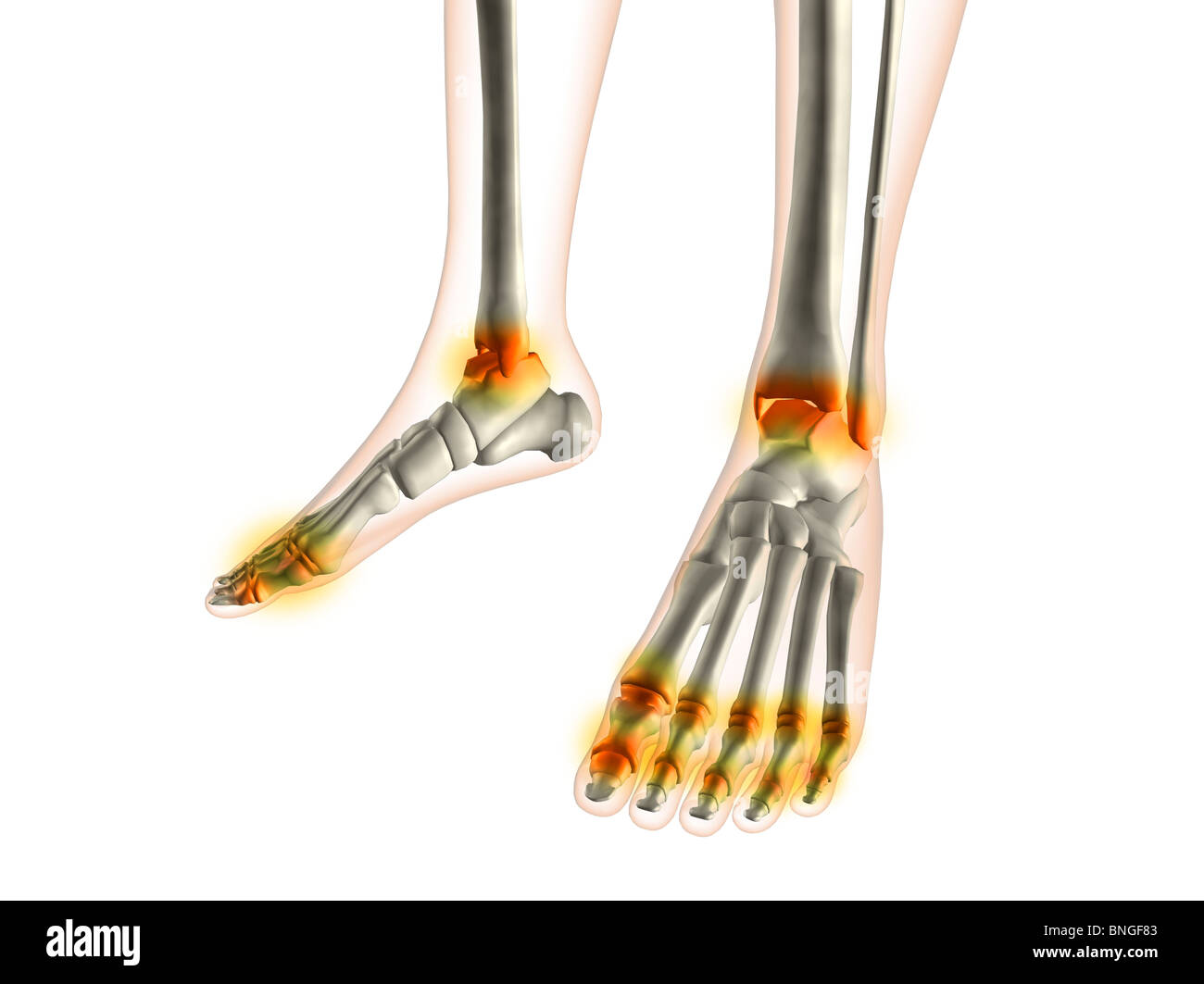 X-ray view of inflamed foot bones Stock Photo - Alamy