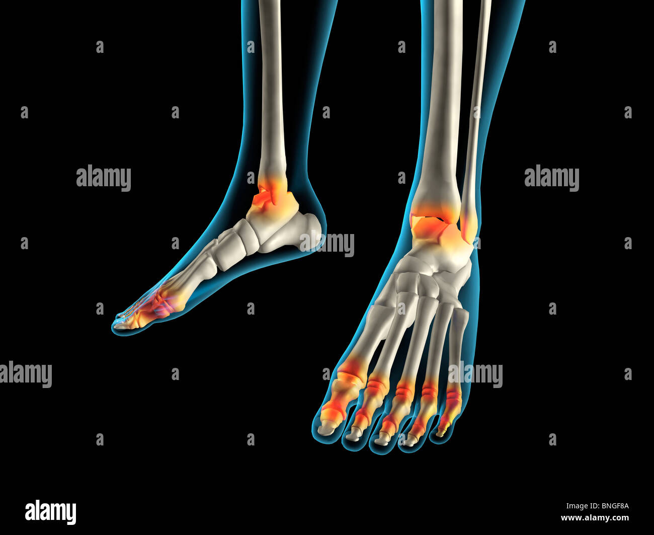 Inflamed foot hi-res stock photography and images - Alamy