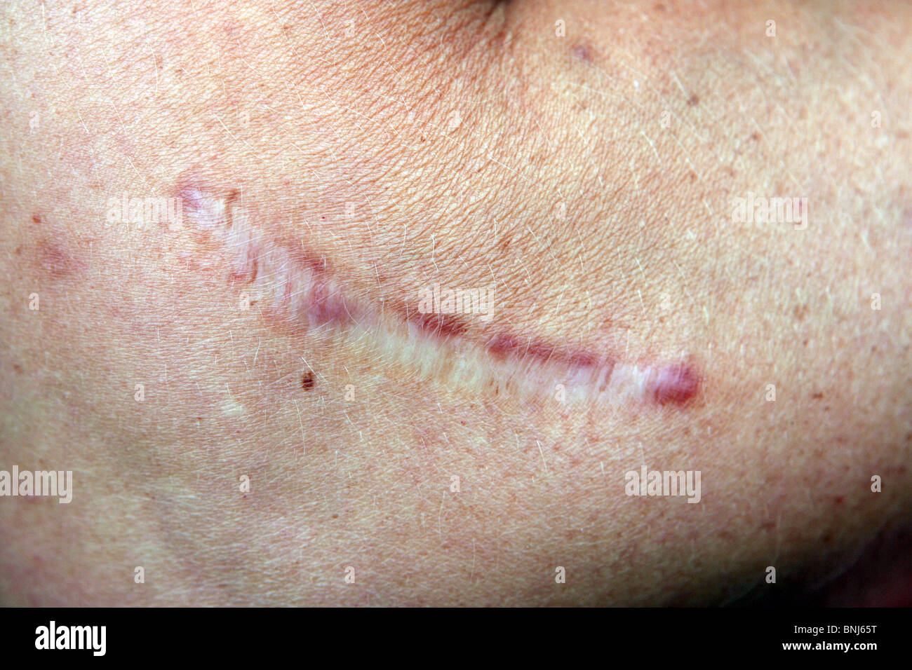 Elbow wound hi-res stock photography and images - Alamy