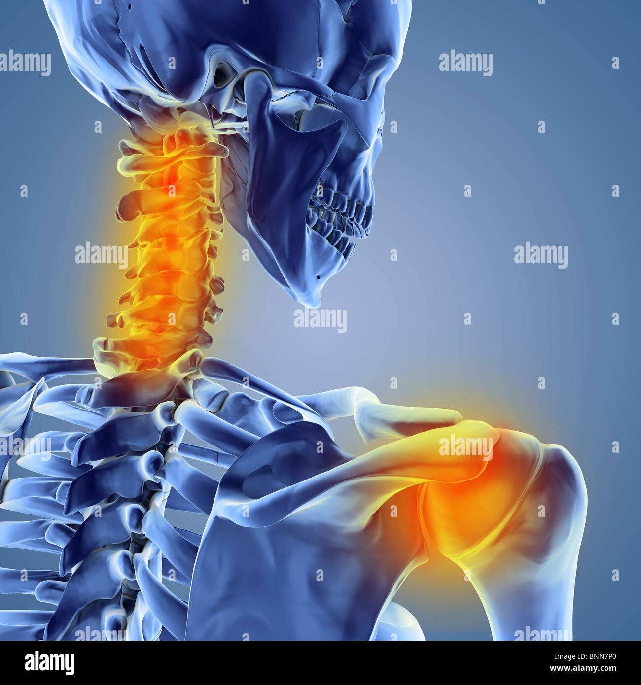 Neck and shoulder pain, computer artwork Stock Photo - Alamy