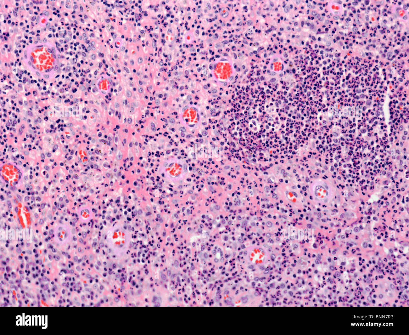 Chronic abscess, light micrograph Stock Photo - Alamy