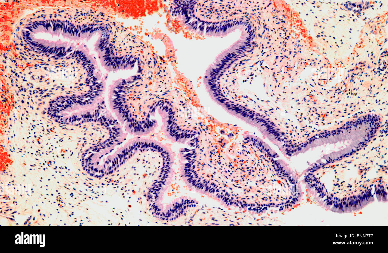 Polypoidal mass hi-res stock photography and images - Alamy