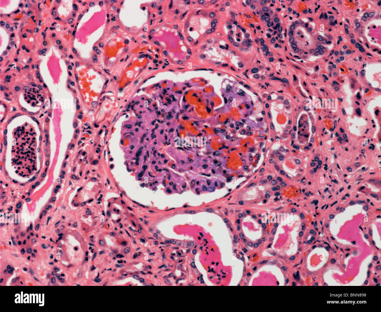 Inflamed kidney, light micrograph Stock Photo - Alamy