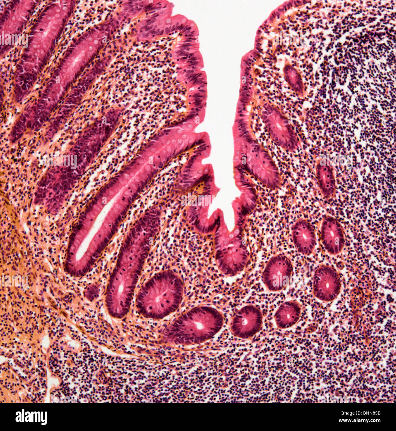 Appendicitis, light micrograph Stock Photo - Alamy