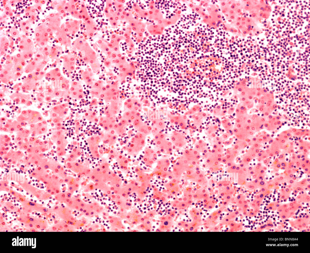 Leukaemia blood cells, light micrograph Stock Photo - Alamy