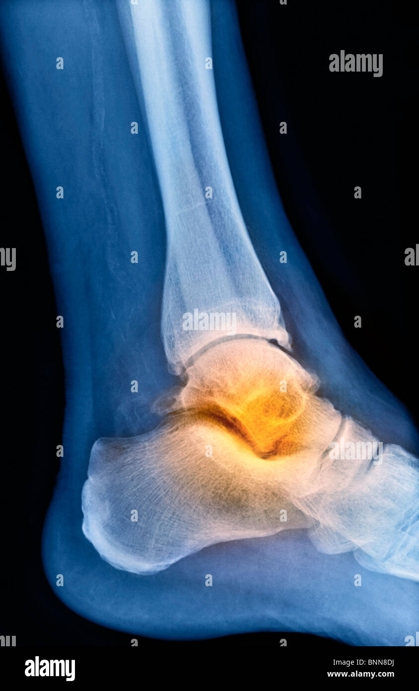X Ray Ankle Cpt