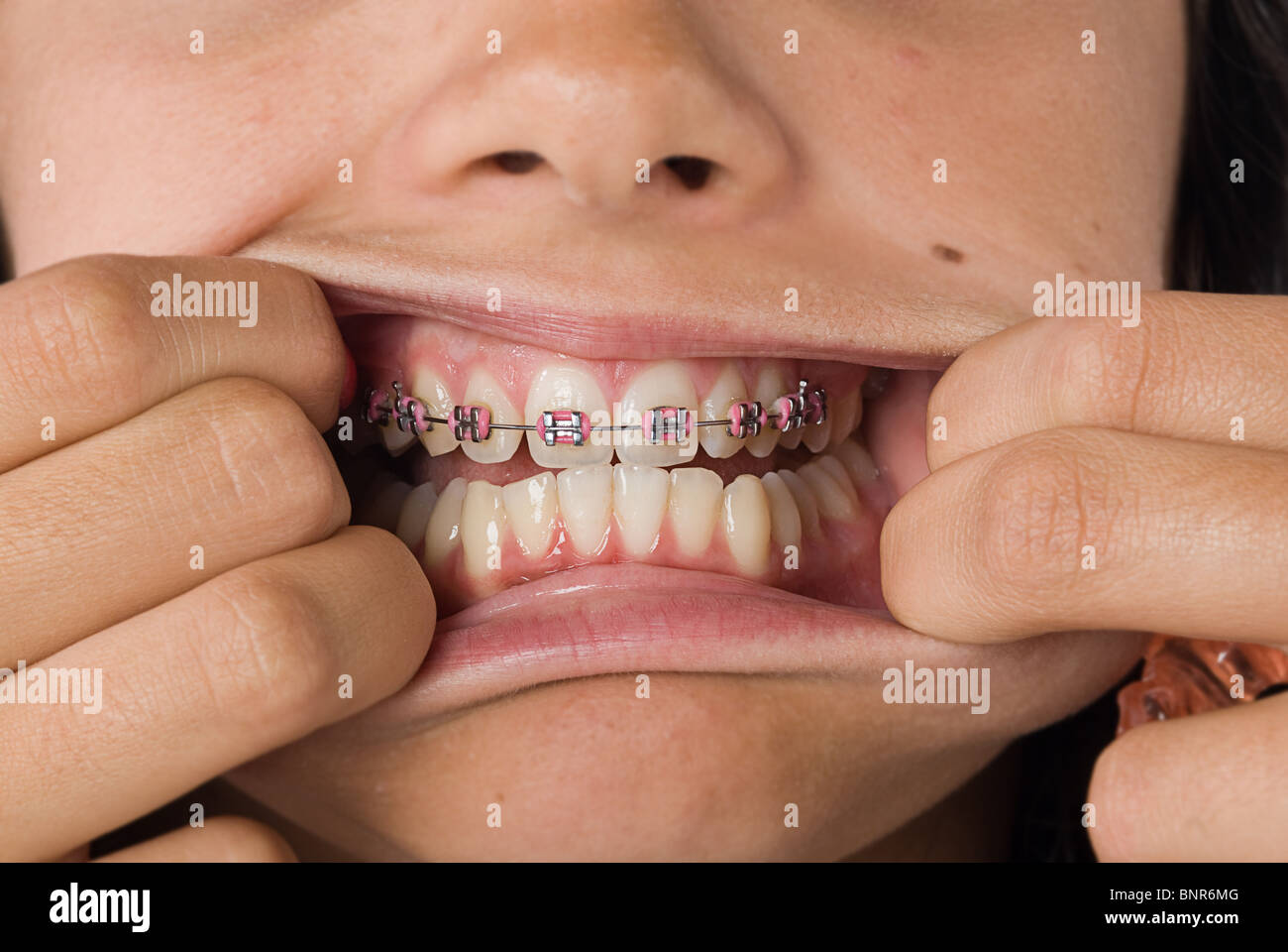Child incisor teeth hi-res stock photography and images - Alamy
