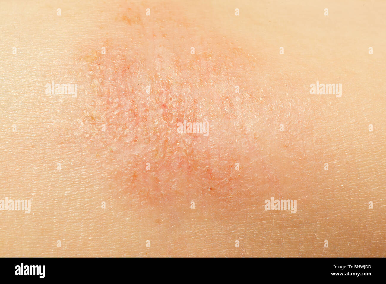 Eczema hi-res stock photography and images - Alamy