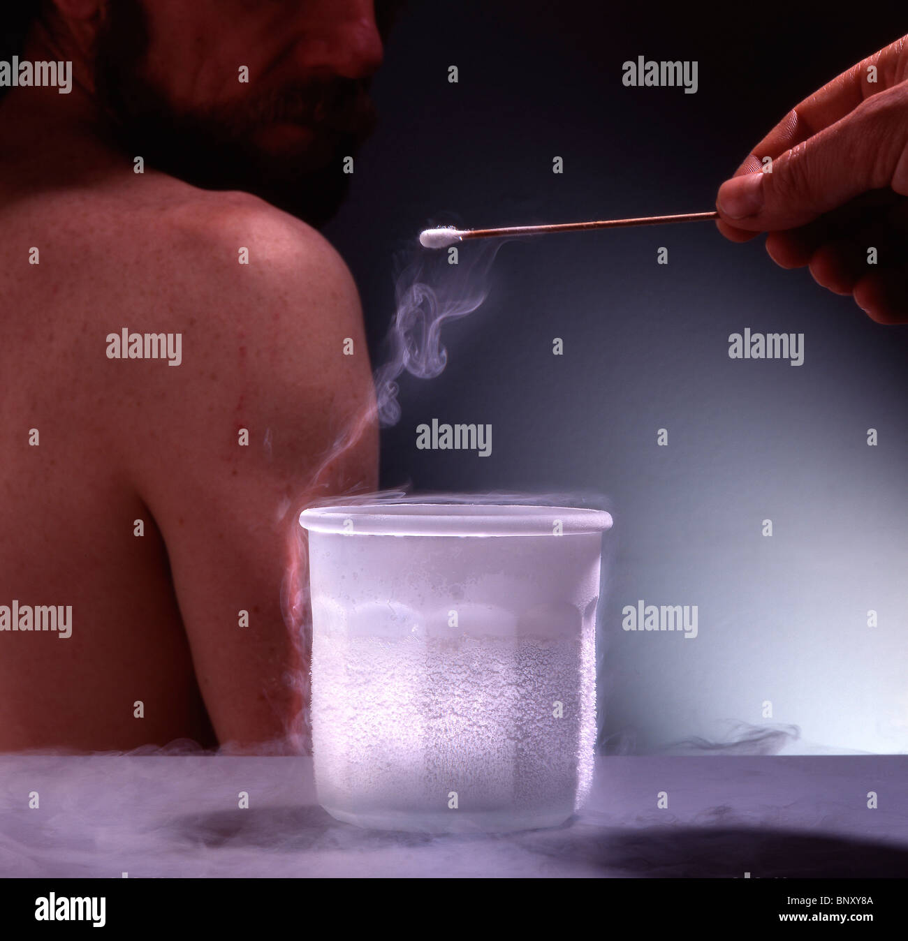 medical freeze therapy Stock Photo - Alamy