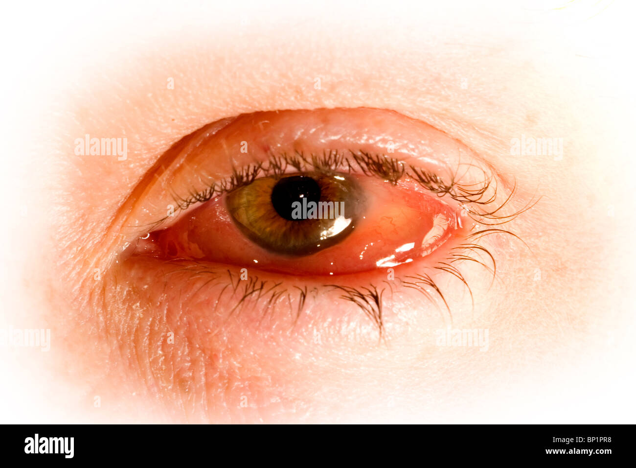 Eye infection hi-res stock photography and images - Alamy