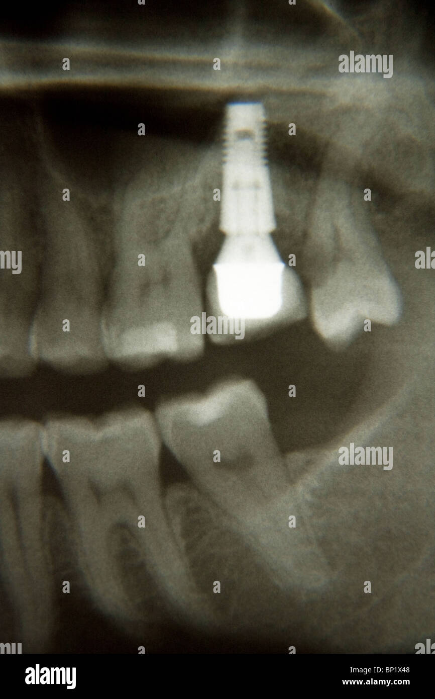 Dental implant of radiograph Stock Photo - Alamy