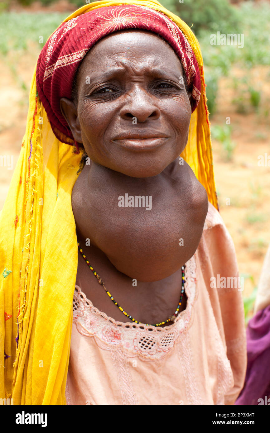 Goiter woman hi-res stock photography and images - Alamy