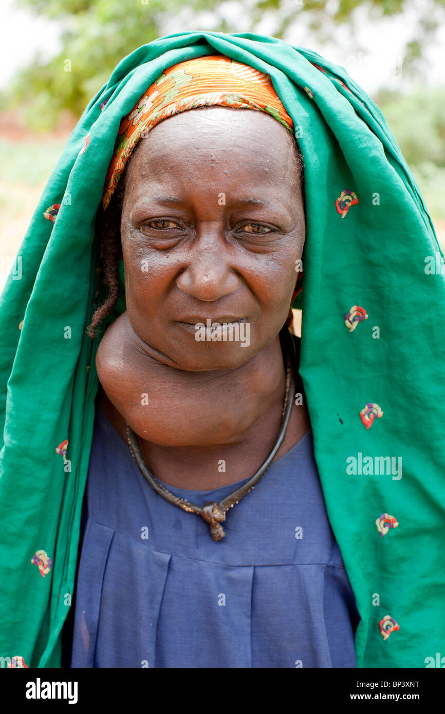 Goiter woman hi-res stock photography and images - Alamy