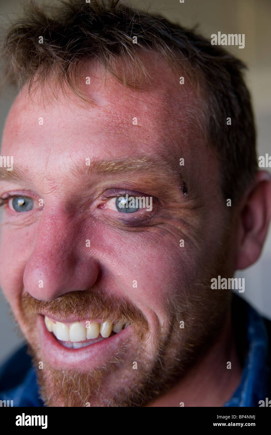 Black eye hi-res stock photography and images - Alamy