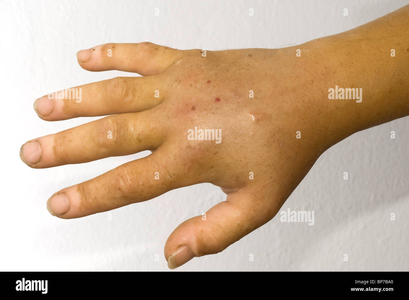 Snake bite hand hi-res stock photography and images - Alamy
