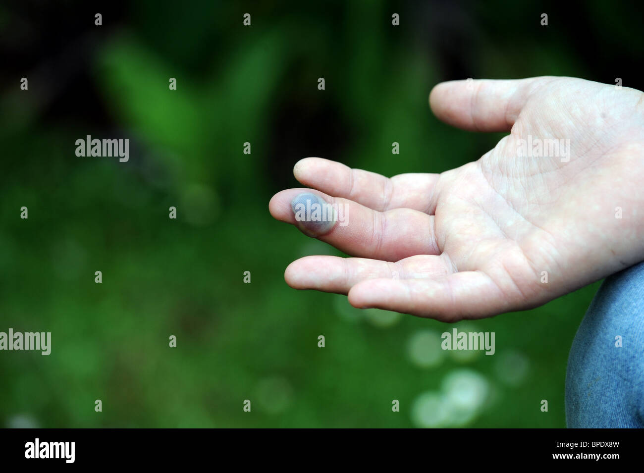 A man's hand after he was bitten by an Adder and suffered a bad ...