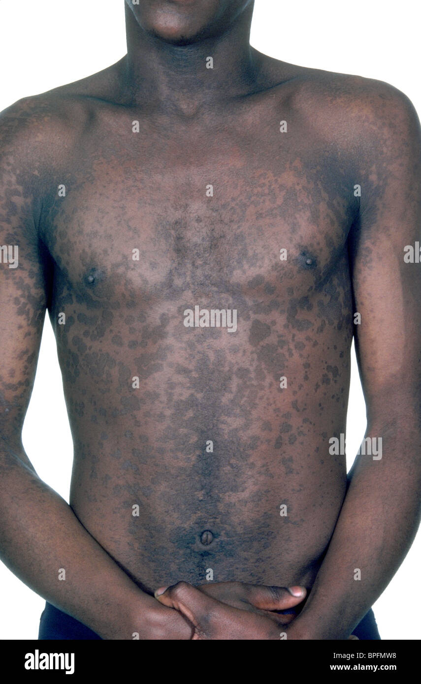 Tinea Versicolor Before And After