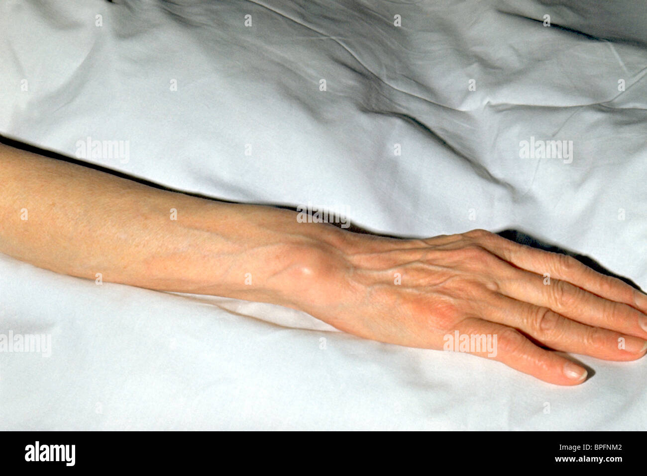 Photograph of a fraction to the wrist that has healed in an abnormal ...