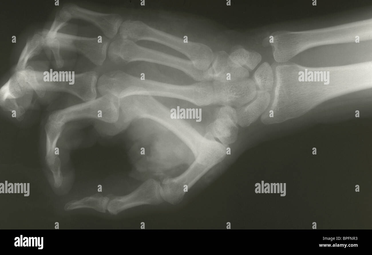 An x ray of the right hand which has suffered trauma to the hand and ...