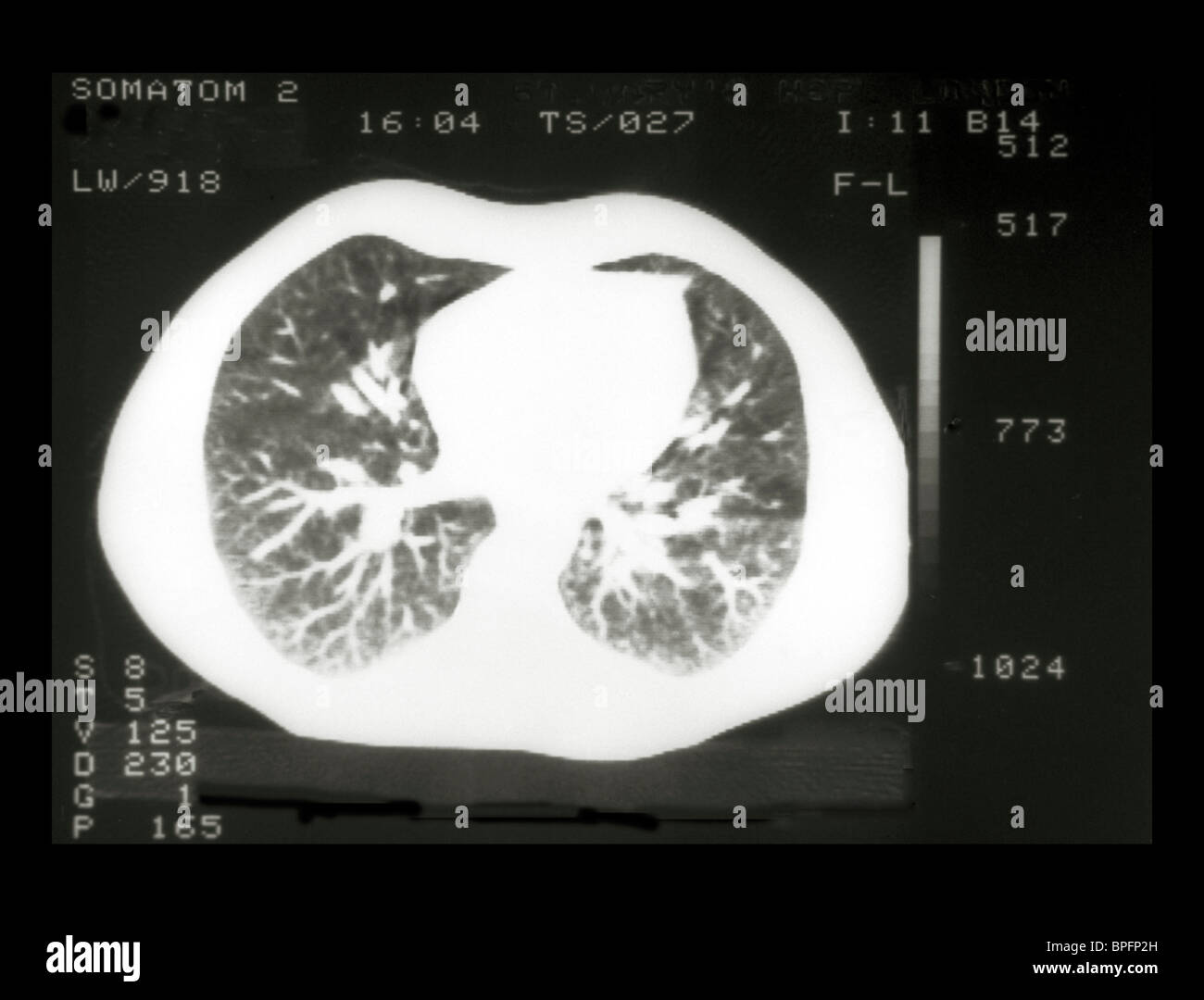 Normal lung hi-res stock photography and images - Alamy