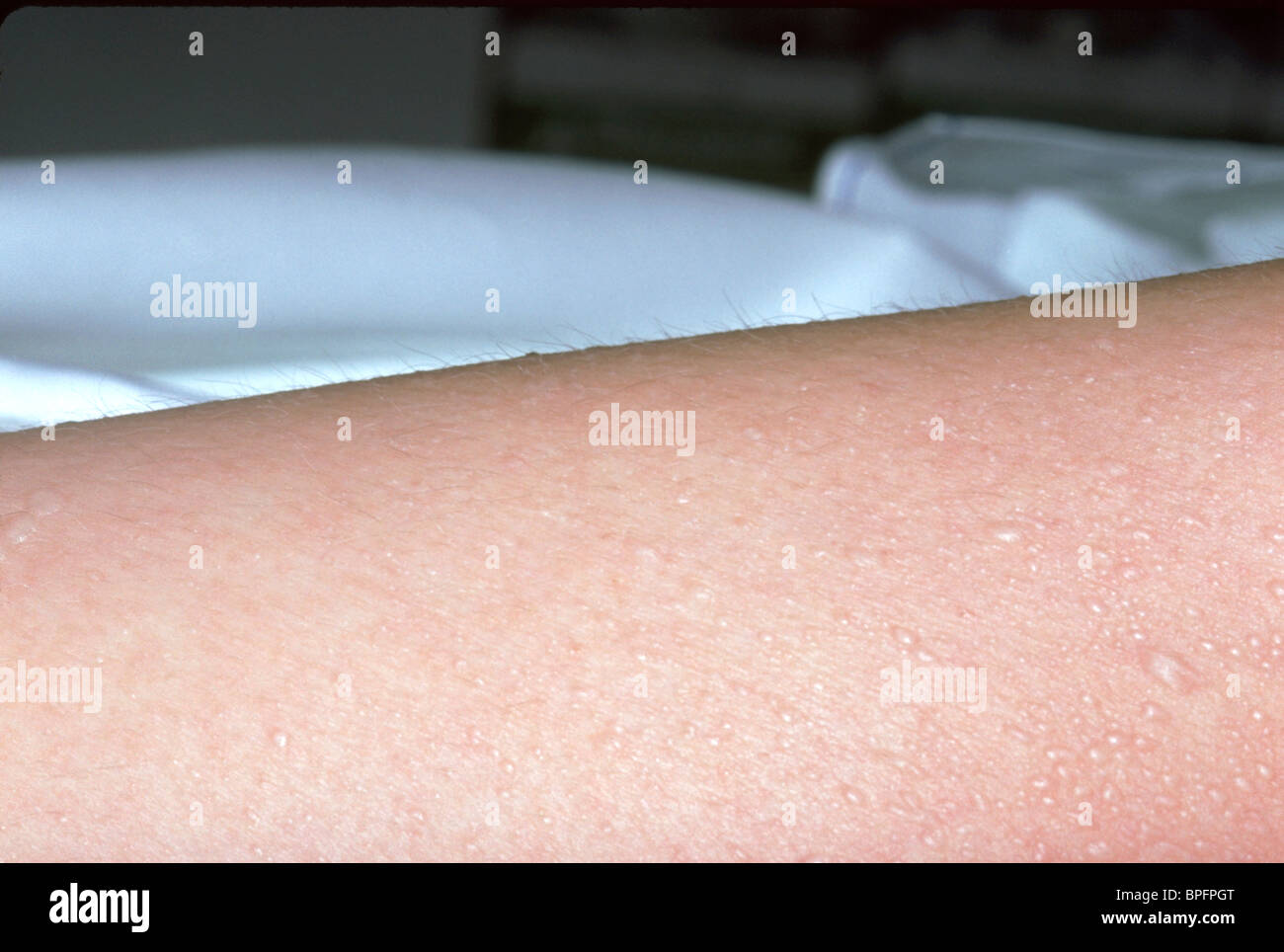 Blisters swelling hi-res stock photography and images - Alamy