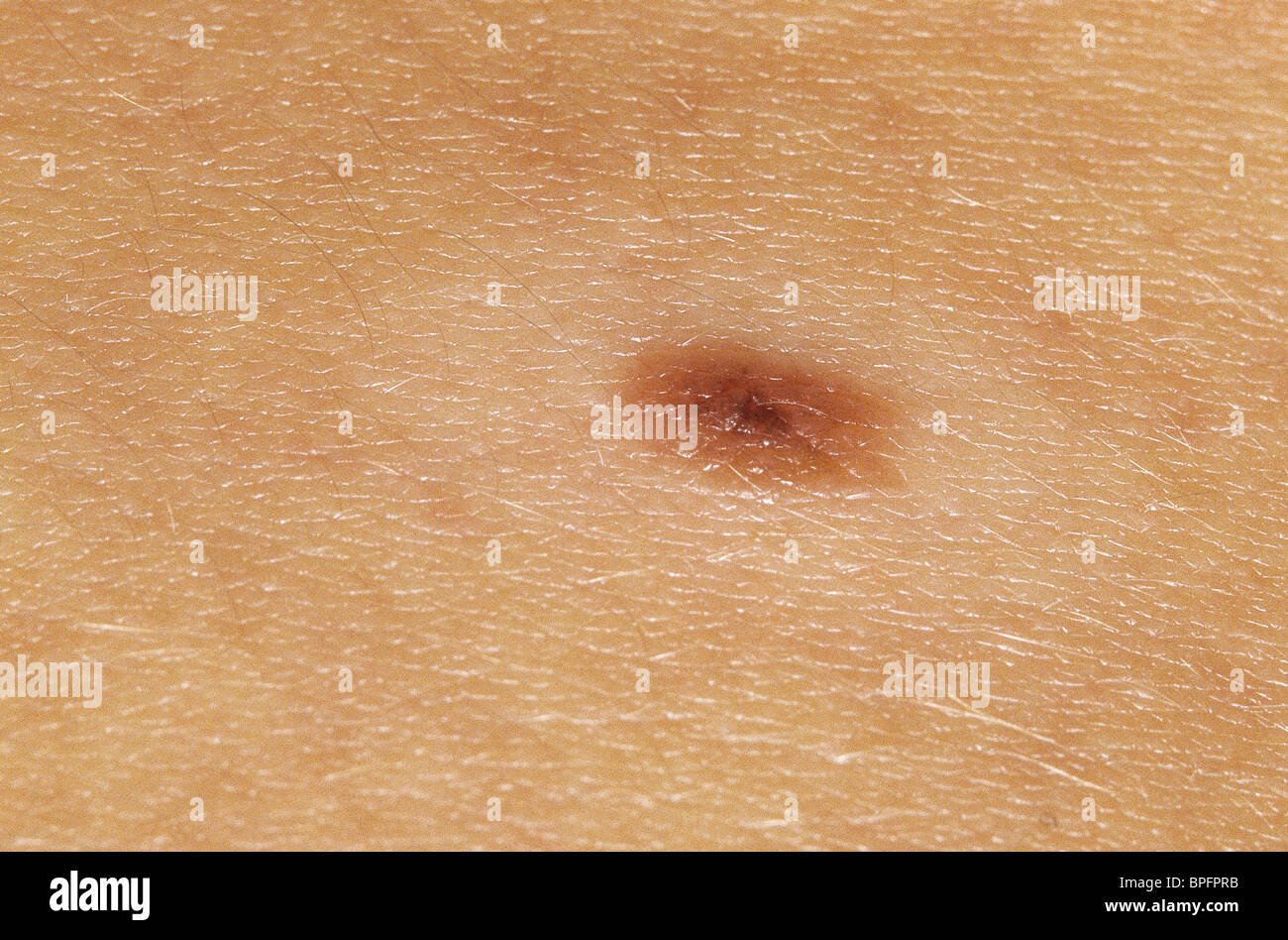 Halo Nevus