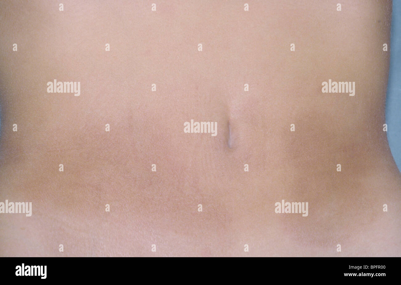 Atrophoderma is the wasting away or a decrease in the size of the skin ...