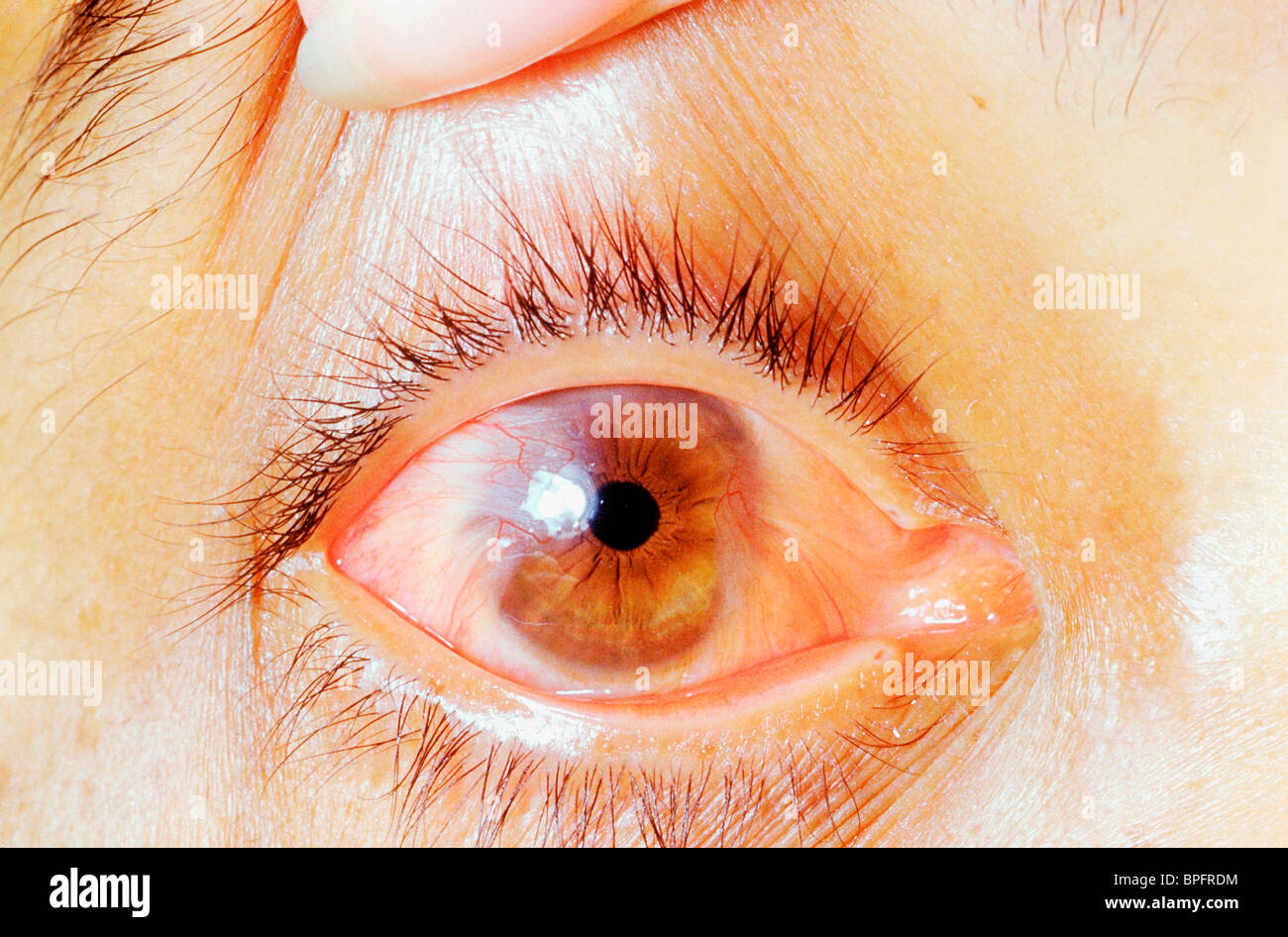Pterygium is a superficial growth of vascular tissue radiating in a ...