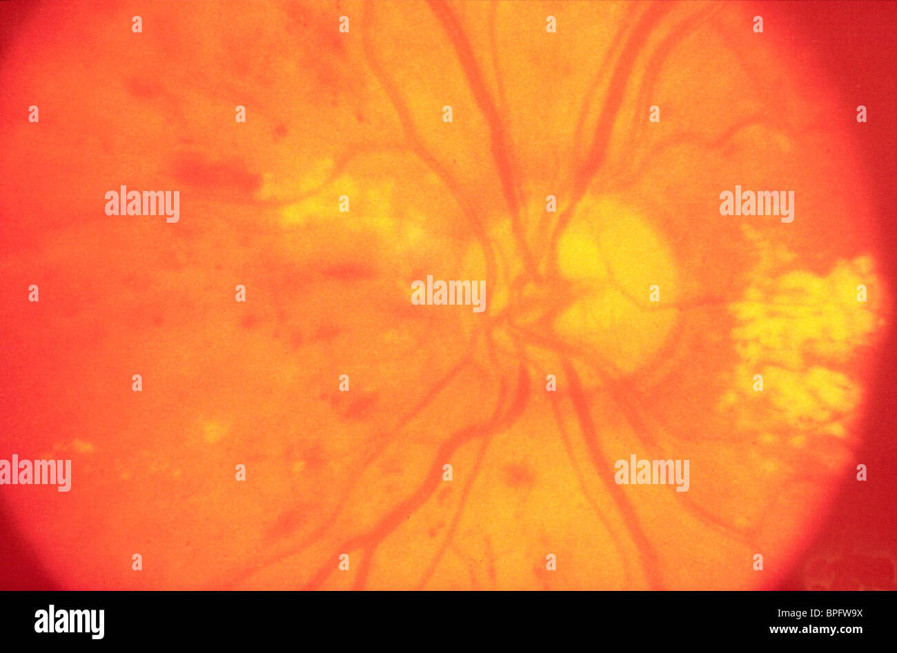 EXUDATES AND HAEMORRHAGES ON RETINA Stock Photo - Alamy