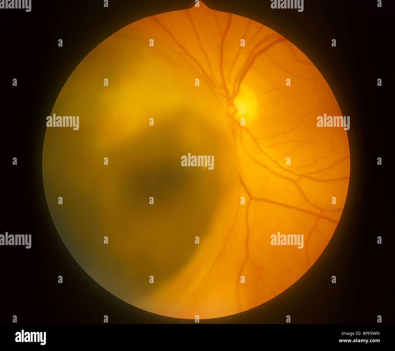 Retinal melanoma hi-res stock photography and images - Alamy