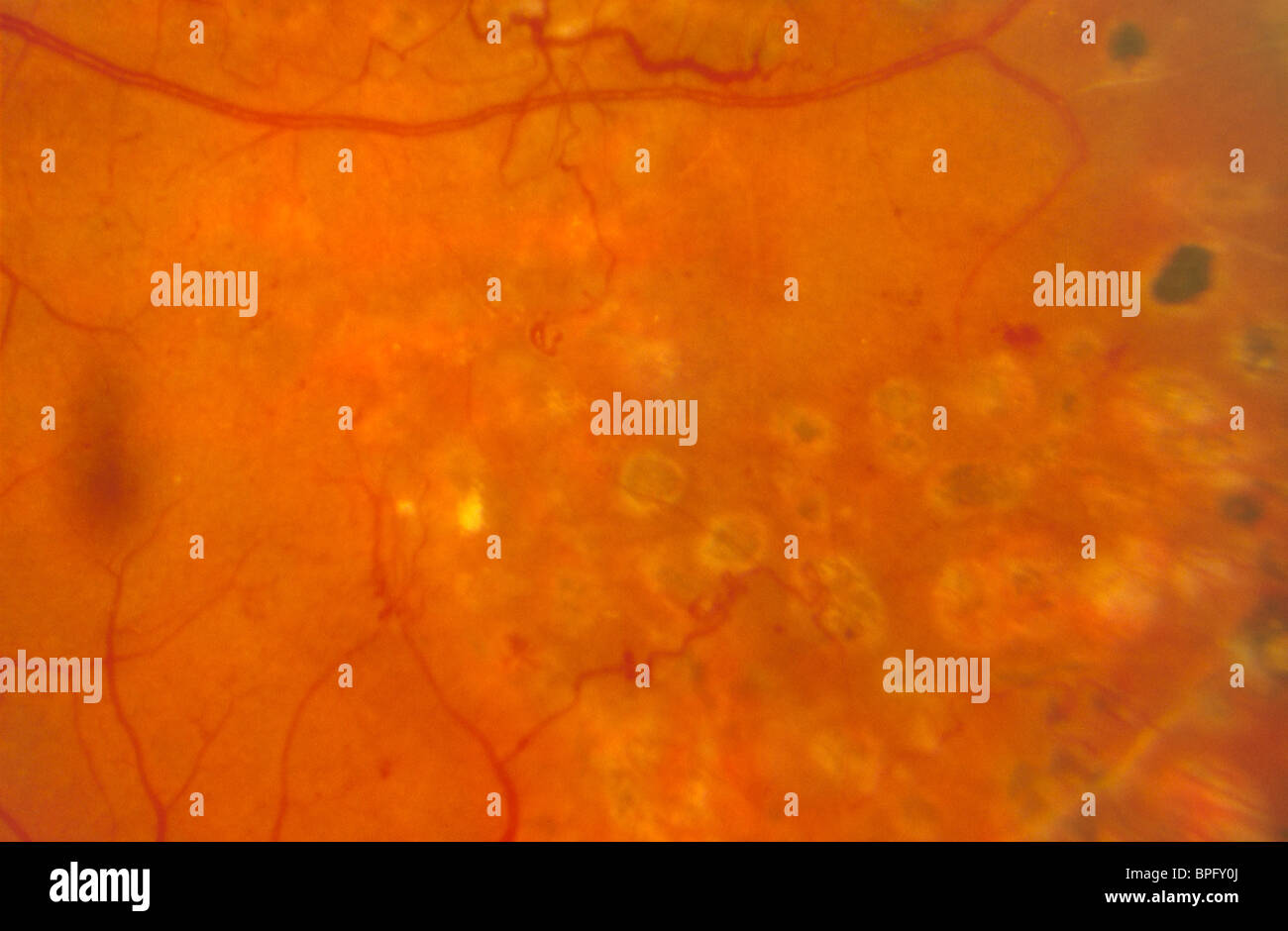 A retinal photograph showing laser scars on the retina Stock Photo - Alamy