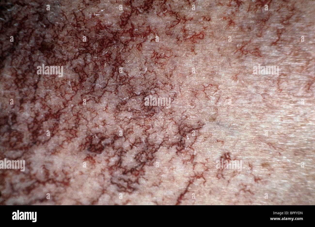 Telangiectasia hi-res stock photography and images - Alamy