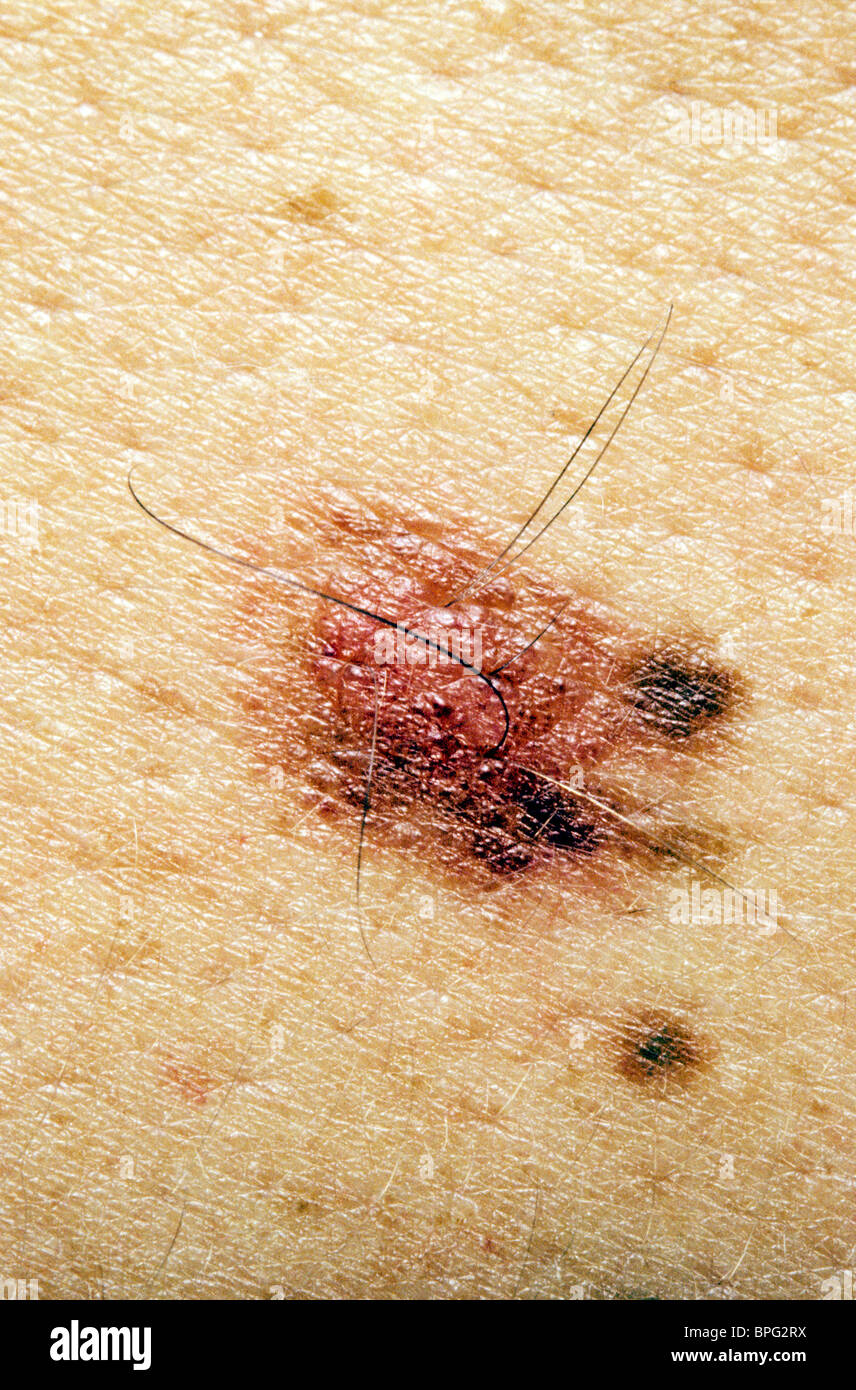 Congenital nevus hi-res stock photography and images - Alamy