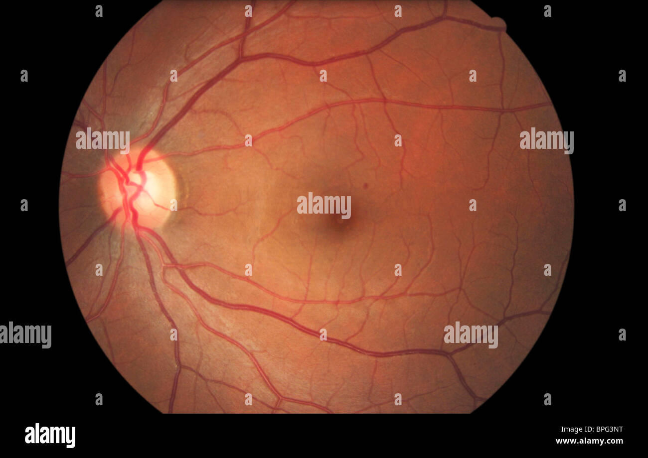 Diabetic retinopathy hi-res stock photography and images - Alamy