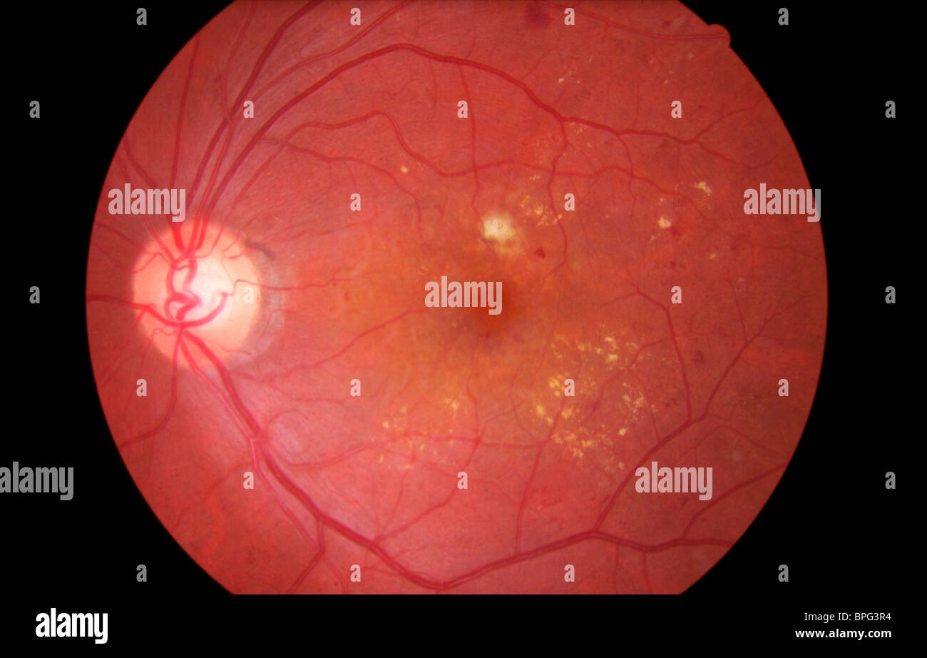 Diabetic maculopathy. View of the retina of a diabetic patient showing ...