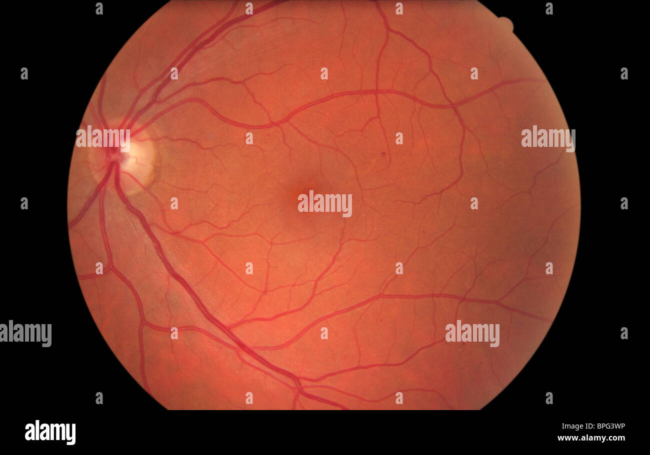 Background diabetic retinopathy or BDR is named appropriately because ...
