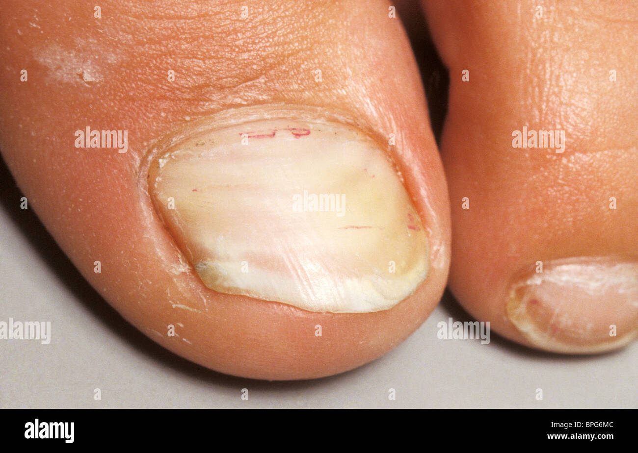 Congenital leukonychia of toenails, leukonychia is the most common ...