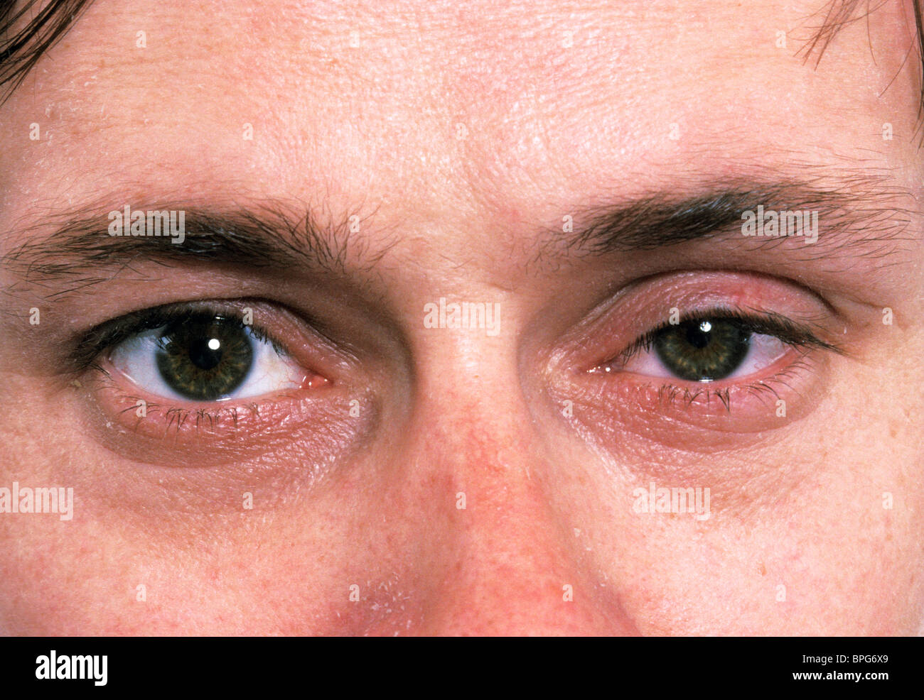 Horners Syndrome in male Stock Photo - Alamy