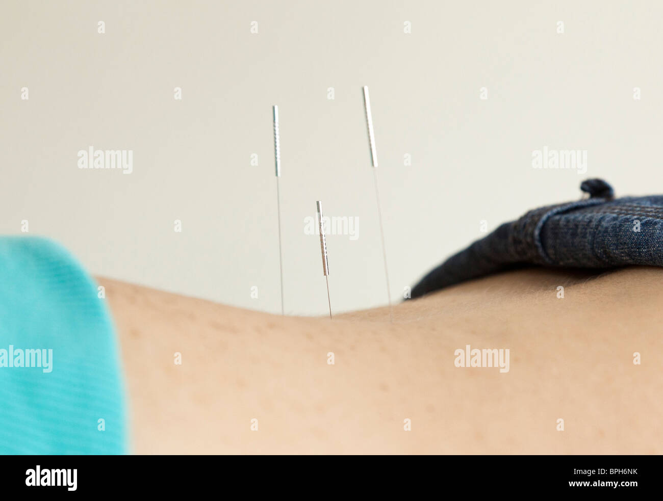 acupuncture needles in a patient Stock Photo - Alamy
