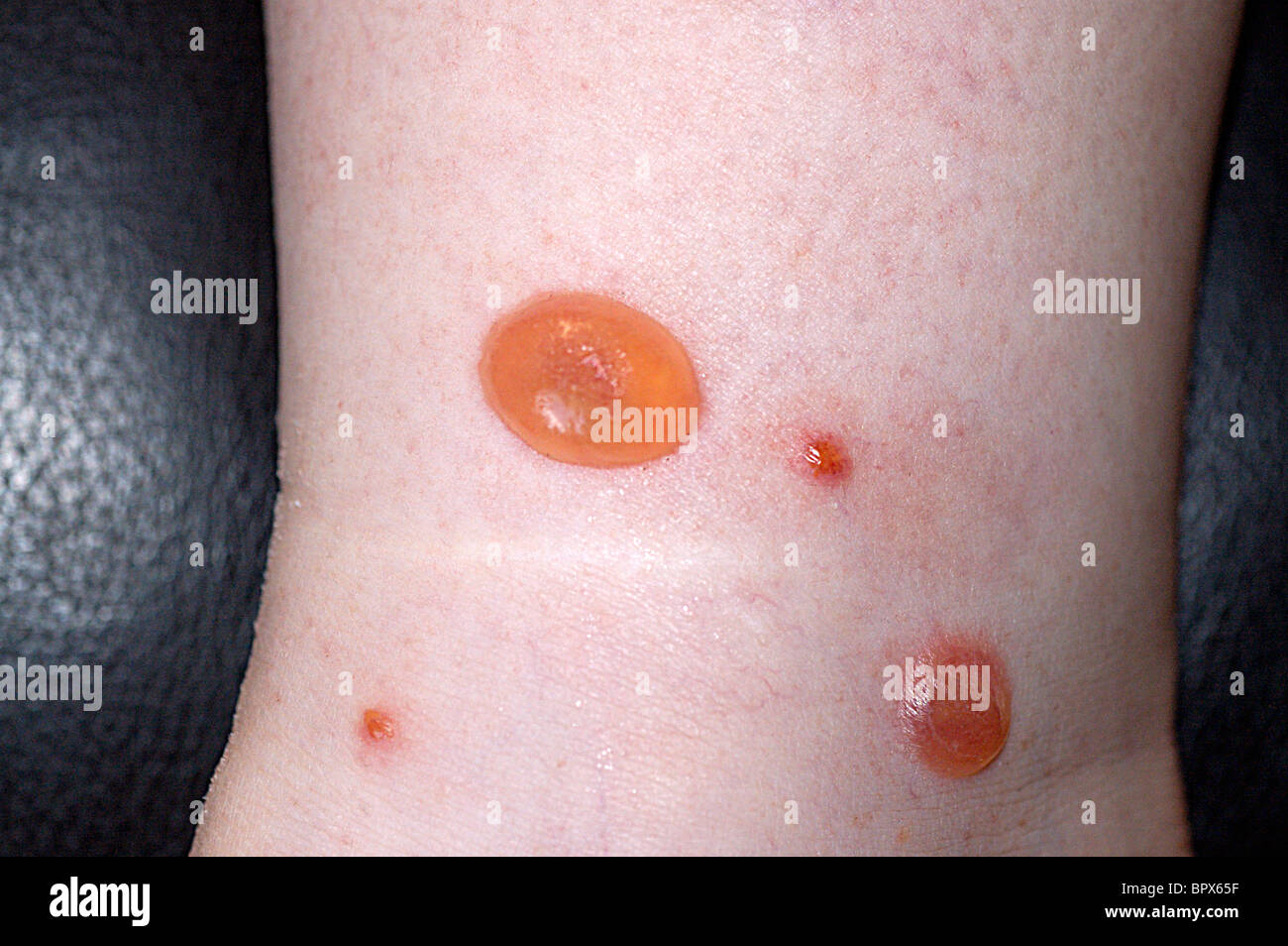 Harvest mite bites (Trombicula autumnalis) around ankle area Stock ...