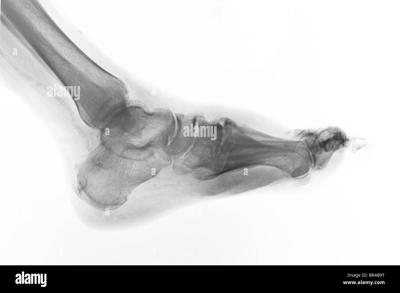 x-ray of the foot of a 68 year old woman with diabetes Stock Photo - Alamy