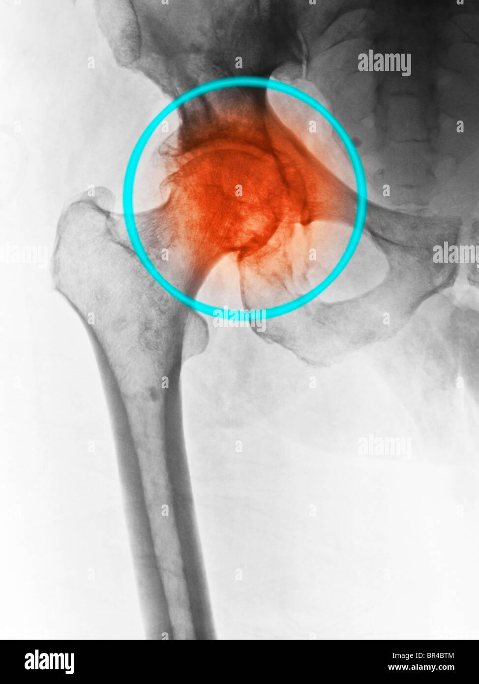 Hip fracture hi-res stock photography and images - Alamy