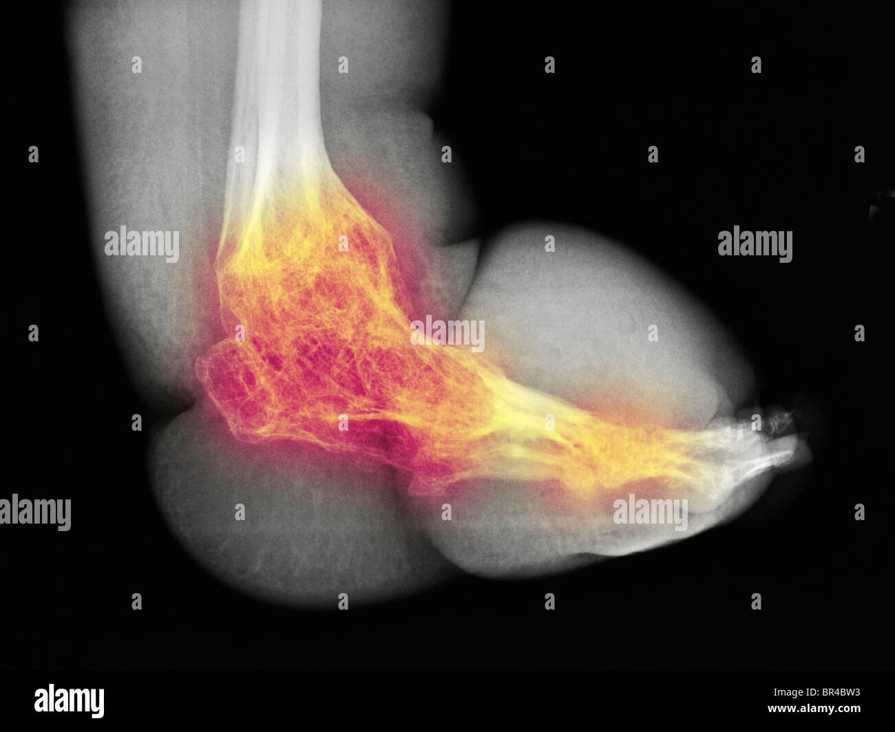 leg and foot x-ray of a 63 year old man with paraplegia and extensive ...