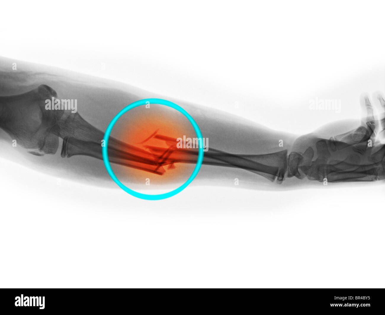 x-ray of a forearm fracture in an 11 year old boy Stock Photo - Alamy