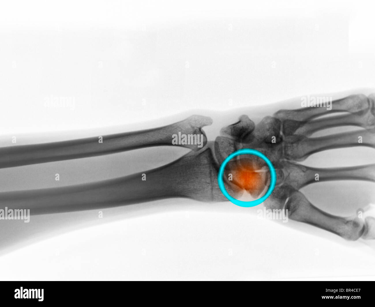 hand x-ray showing a fracture of the navicular or scaphoid bone of the ...