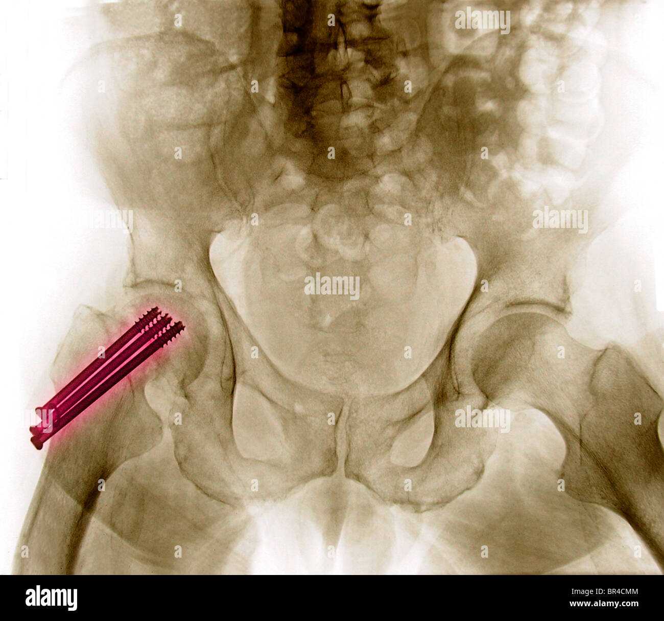 Hip fracture recovery hi-res stock photography and images - Alamy