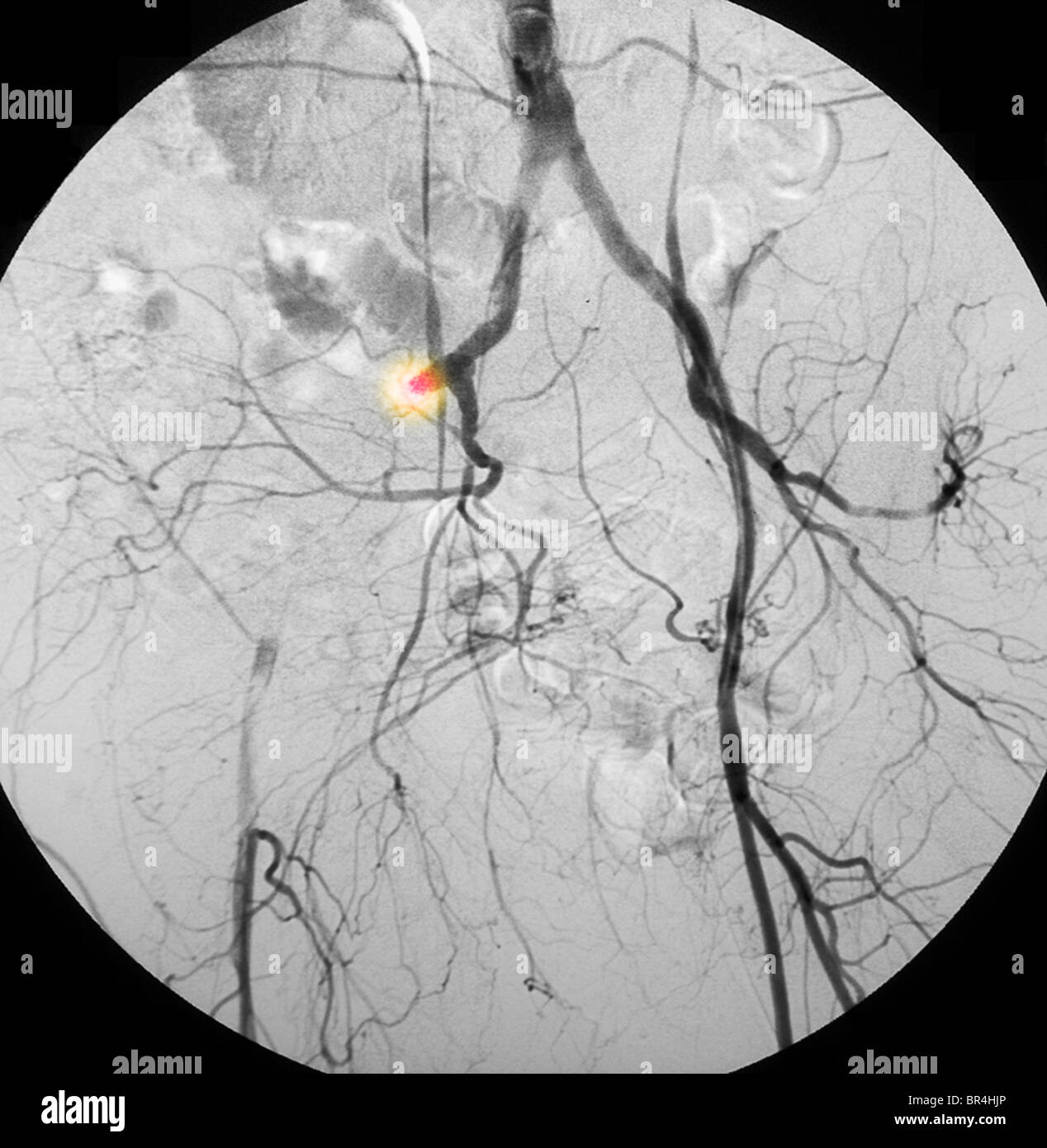 Angiogram hi-res stock photography and images - Alamy