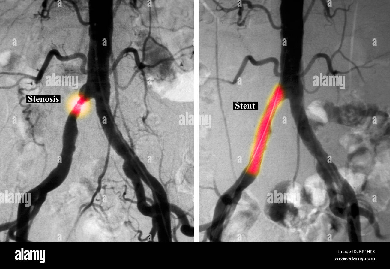 angiogram of a 65 year old man showing the placement of a stent in the ...